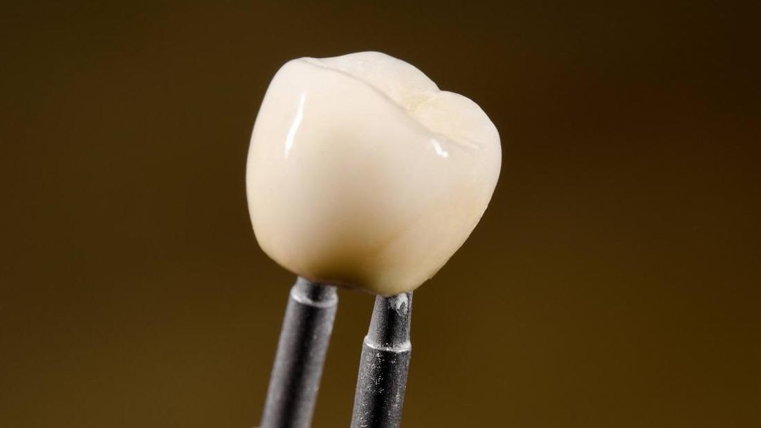 Repair Chipped and Broken Teeth | Dental Crowns Rockville, MD